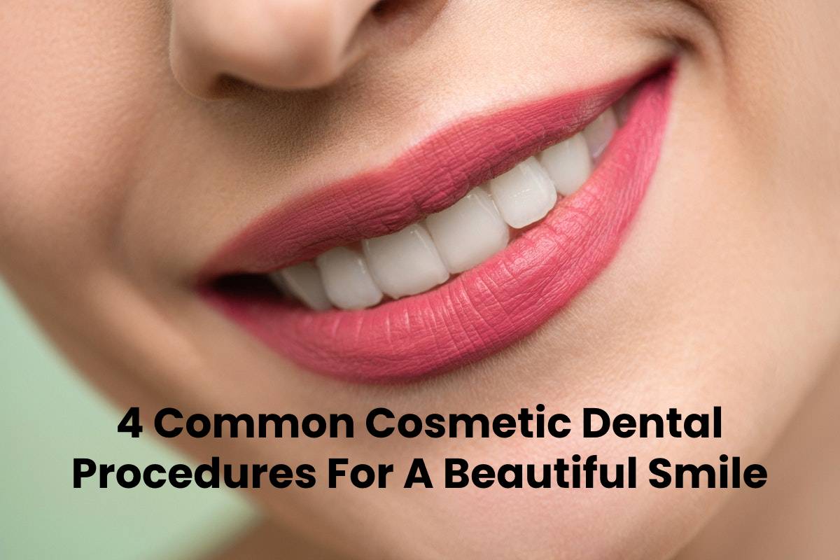 4 Common Cosmetic Dental Procedures: Guide to Veneers